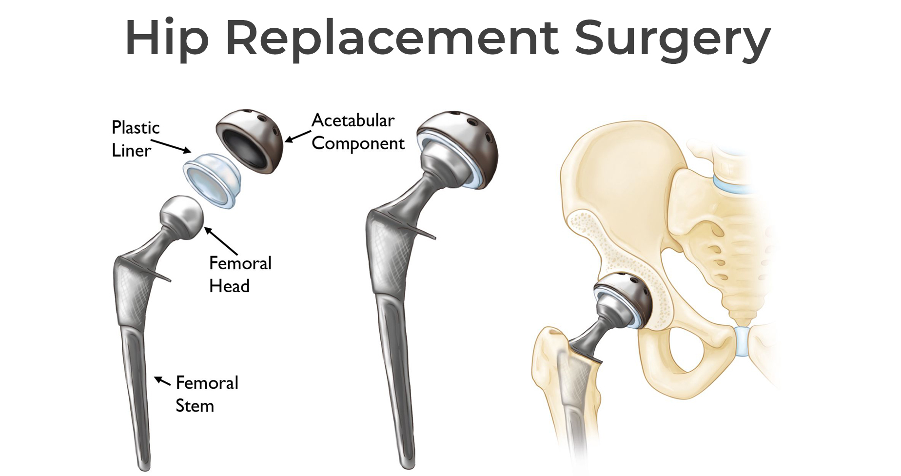 Hip Replacement Surgeon in Baner | Dr. Kapil Saoji